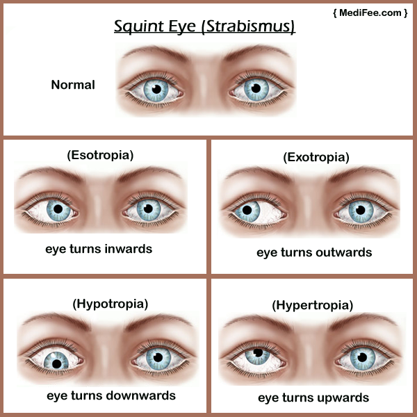 Squint Correction - Kanhaiyalal Vinodkumari Memorial Eye Hospital